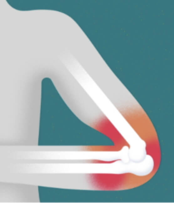 What is Psoriatic Arthritis? | Bimzelx (bimekizumab-bkzx)