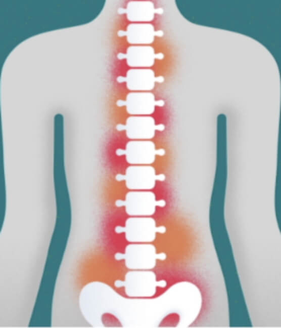 What is nr-axSpA? | Bimzelx (bimekizumab-bkzx)