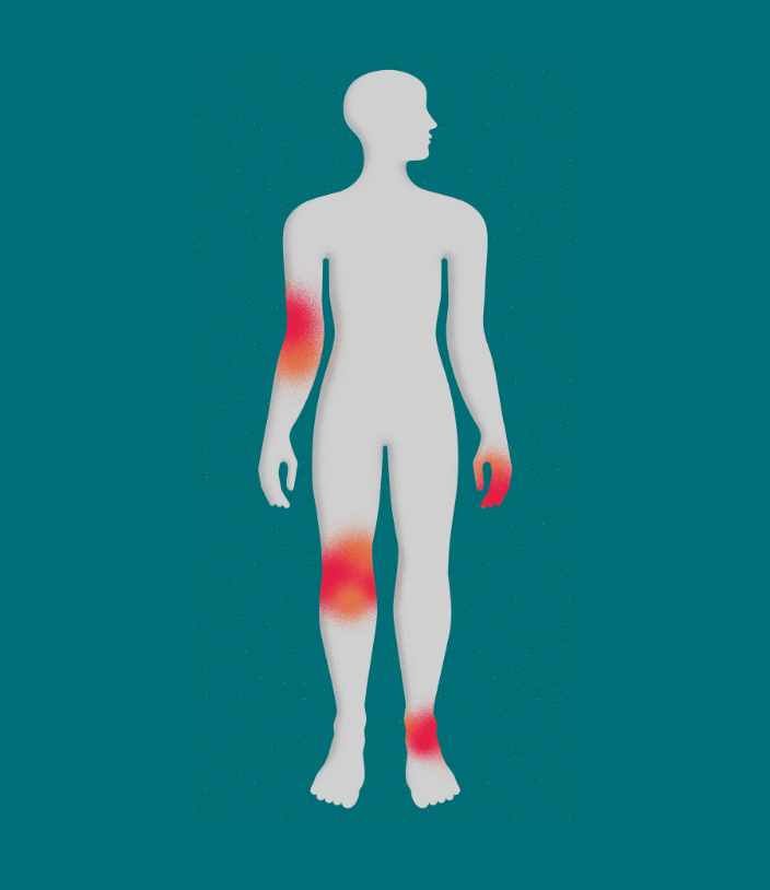 What is Psoriatic Arthritis? | Bimzelx (bimekizumab-bkzx)